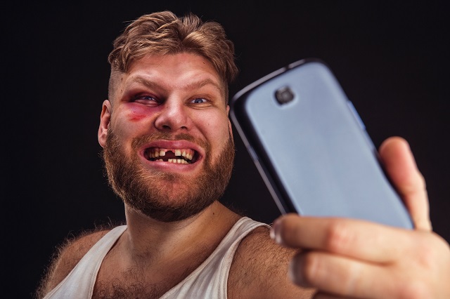 Jak pozbyć się siniaka pod okiem - Masz podbite oko, limo? Działaj szybko