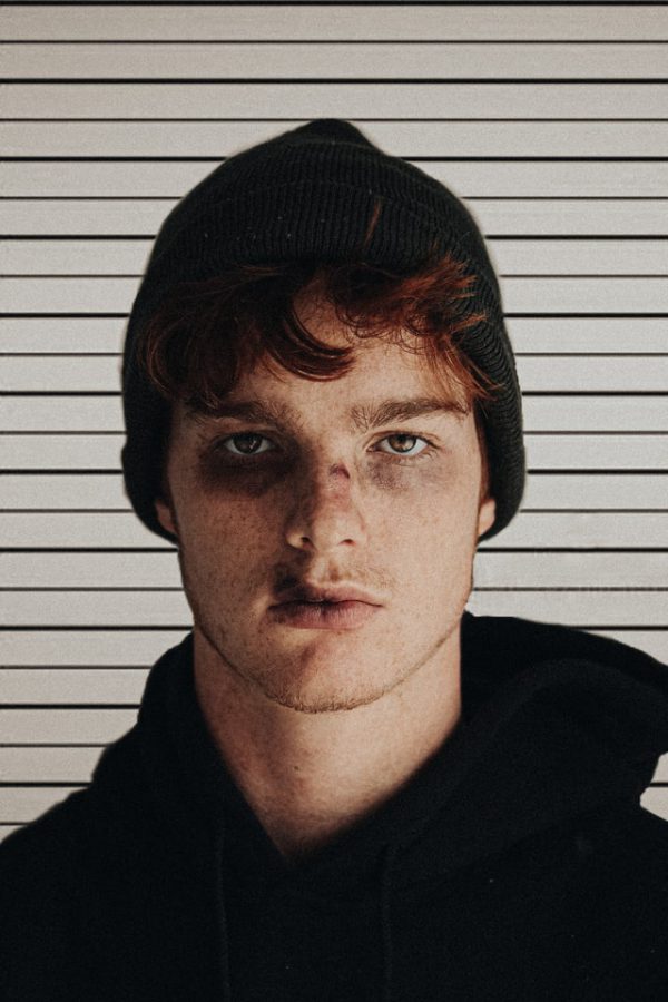 Jak pozbyć się siniaka pod okiem - Masz podbite oko, limo? Działaj szybko