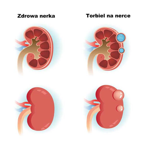 Czy torbiel na nerce może się wchłonąć - Leczenie torbieli nerek